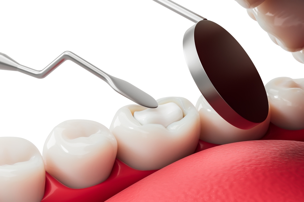 What Is a White Filling Treatment? Can a White Filling Fix a Chipped Tooth?